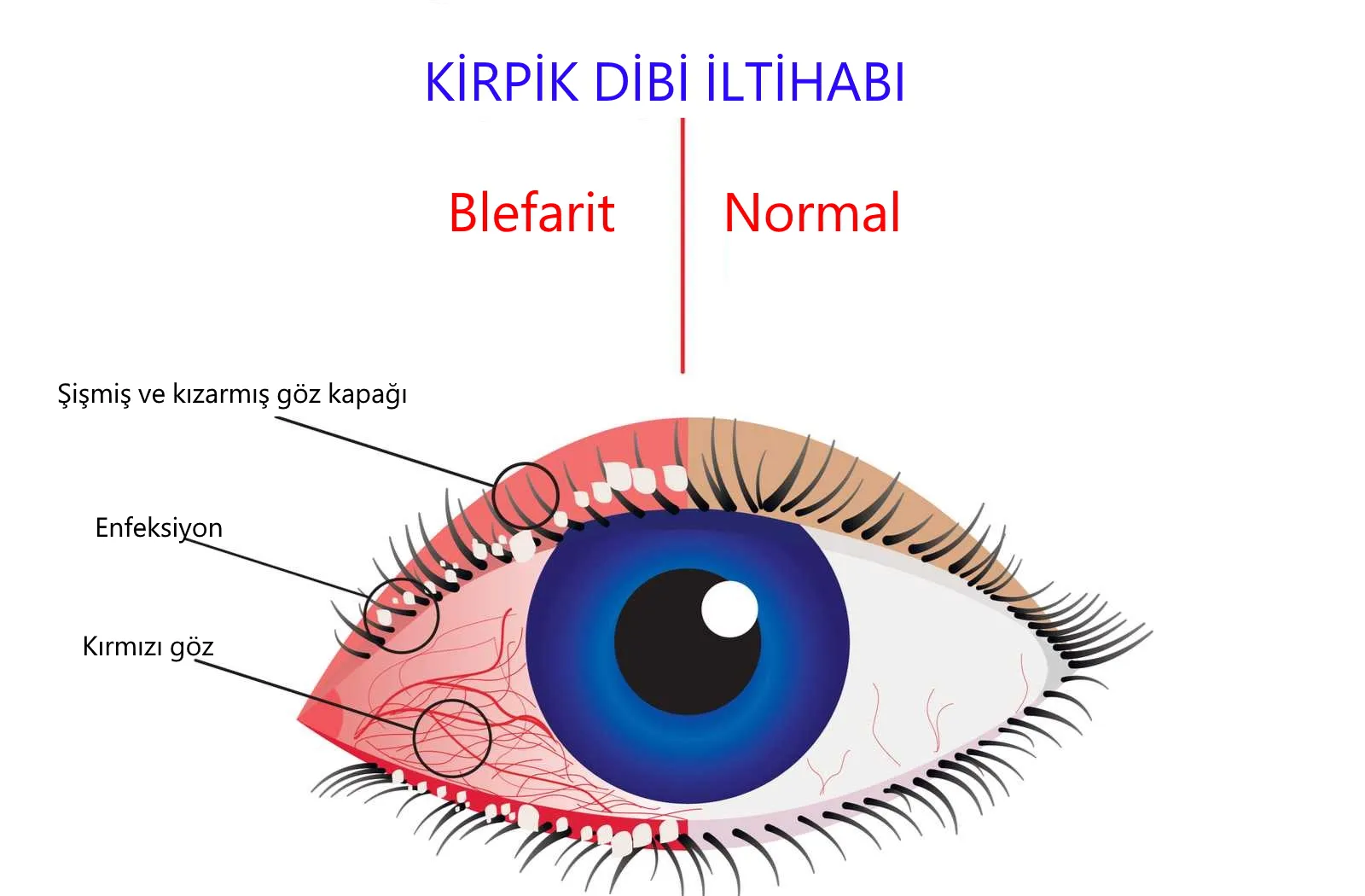 Blefarit (Göz kapağı iltihapı) - Optikbilgi